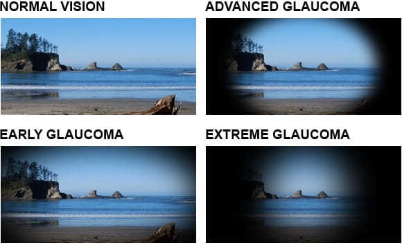 What is Glaucoma? Testing and Treatment - Lee's Summit Eye Doctor